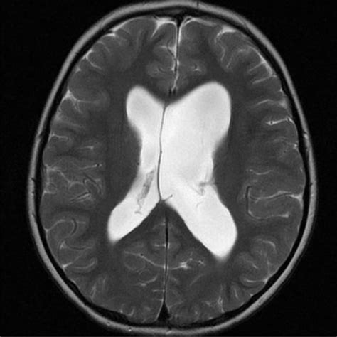 Endoscopic Fenestration Of Suprasellar Arachnoid Cyst 1d Encyclopedia Of Neuroendoscopic