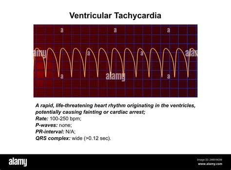 Ventricular Tachycardia Heartbeat Rhythm Illustration Stock Photo Alamy