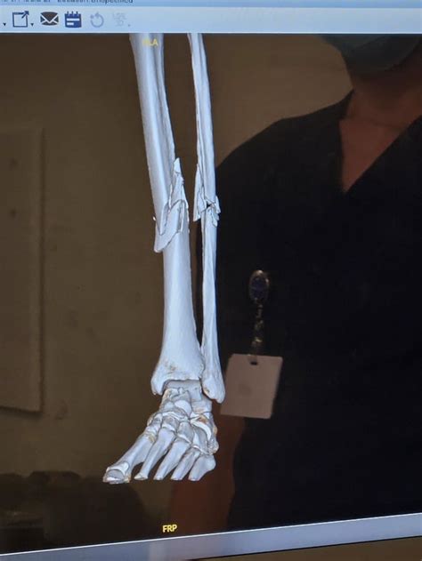 Tib And Fib R Xrayporn