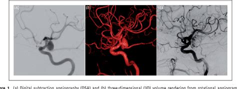 Figure 1 From Pipeline Embolization Device Deployment Via An Envoy Distal Access Xb Guiding