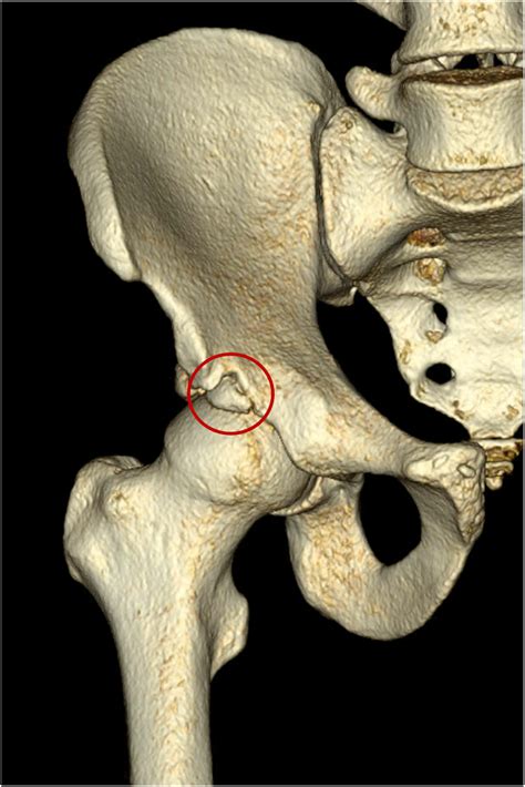 Os Acetabuli Do Not Portend Inferior 2 Year Functional Outcomes In