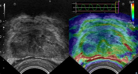 Urology Fujifilm [myanmar]