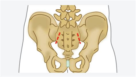 Minimally Invasive Lumbar Fusion Huffman Spine Clinic