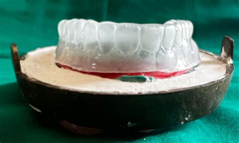 Temporary Putty Spacer Placed Over Master Cast With 2mm Thick Modelling Download Scientific