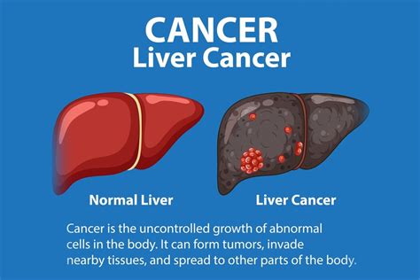 Heres How You Can Prevent Cancer Due To Untreated Diabetes Onlymyhealth