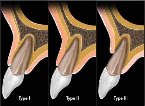 Extraction Socket Preservation When Why How