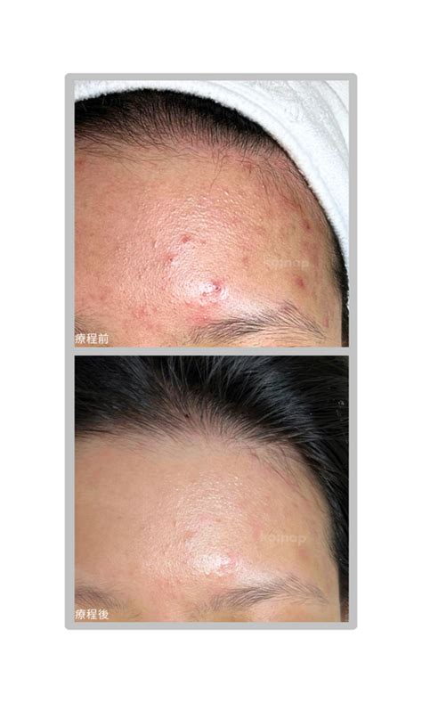 解決暗瘡問題 Ko Nap 日式皮膚管理中心 Konap