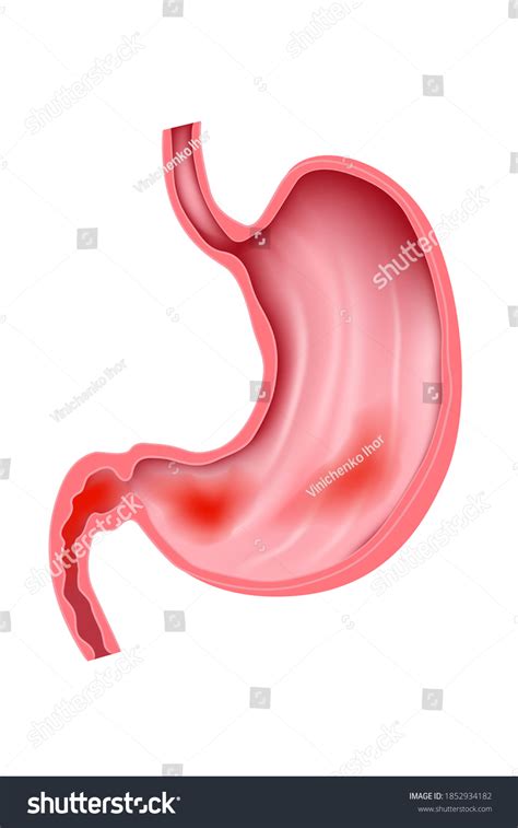 Gastroduodenitis Inflammation Mucous Membranes Stomach Duodenum Stock Vector Royalty Free