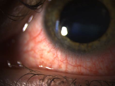 Trantas Dots Laser Vision Lasik Laser Vision Correction