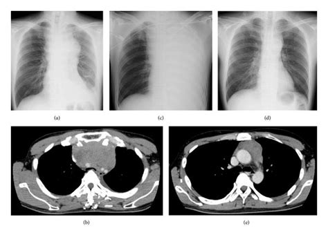 A Cxr Performed On Admission Shows A Widened Mediastinum A A Download Scientific Diagram