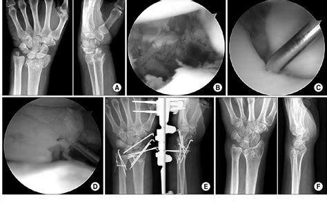 Figure 1 From Management Of Comminuted Intra Articular Fractures Of The Distal Radius