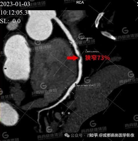 【高尚病例】冠脉cta病例：右冠脉狭窄73进展为慢性完全闭塞cto 知乎