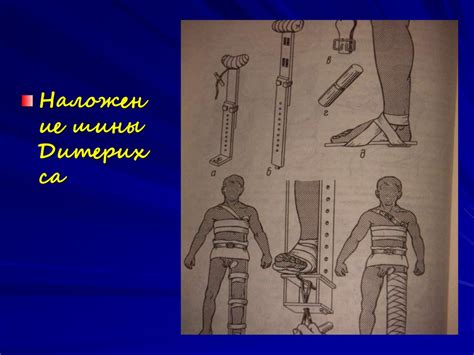 Иммобилизация в травматологии - презентация онлайн