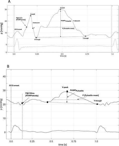 Pulmonary Artery Wedge Pressure Pawp Waveform And The Different