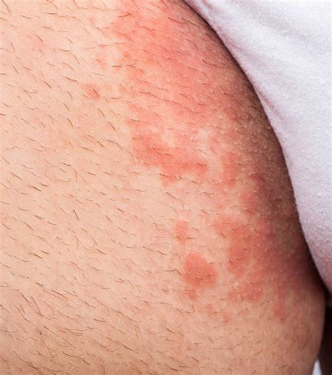 Groin Rash Female