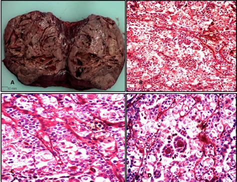 A Gross Findings On Nephrectomy Specimen Large Well Delineated Download Scientific Diagram