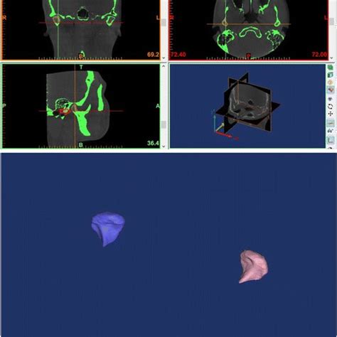 The 3d Reconstruction Of The Condyleᅟ Download Scientific Diagram