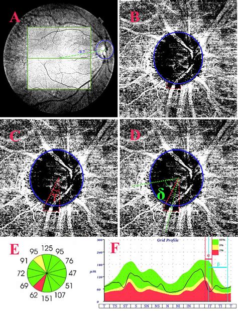 Measurement Of The Angular Circumference And Location Of Mvd And Rnfl