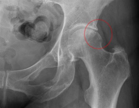 Femoroacetabular Impingement Ep Wellness And Functional Medicine Clinic