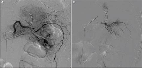 Endovascular Today Embolization For Splenic Trauma April 2016
