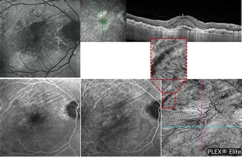 Recognition Diagnosis And Treatment Of Chorioretinal Folds Current P