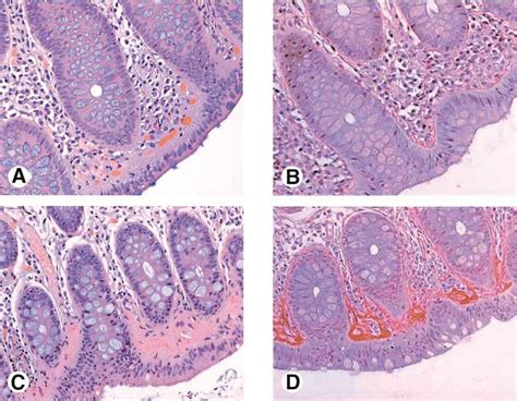 Histology Of Collagenous Colitis Shown Is A Thin Section Of A Biopsy