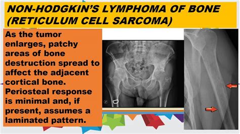 Reticulum Cell Sarcoma X Ray