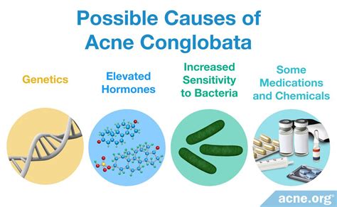 What Is Acne Conglobata