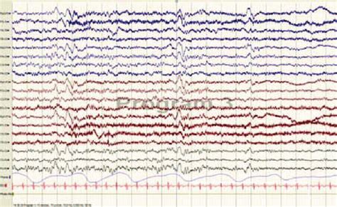 EEG Two Weeks After Admission With Diffuse Slow Wave Activity And Download Scientific Diagram