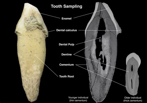Dental Calculus Archaeology Dental Calculus Archaeology
