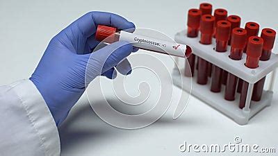 Positive Cryptococcus Test Doctor Showing Blood Sample In Tube Health Checkup Stock Video