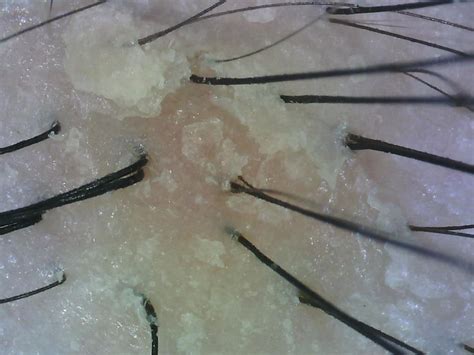 Dandruff Flakes Under Microscope Dandruff Flakes Under Microscope