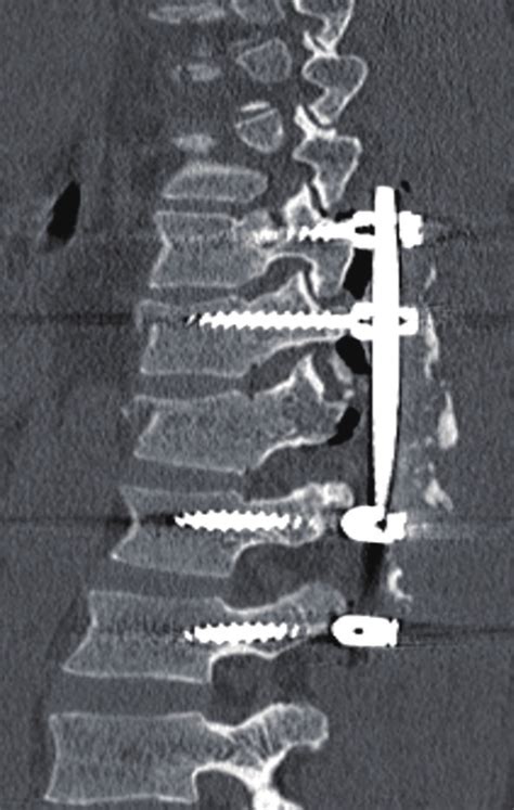 This Post Operative Ct Scan Demonstrates The Standard Operation Download Scientific Diagram