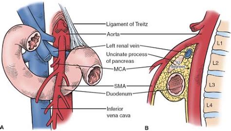 Vascular Compression Of The Duodenum Basicmedical Key