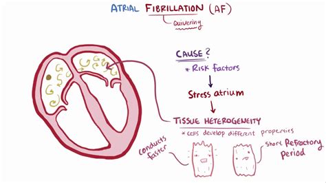 Atrial Fibrillation Pathophysiology