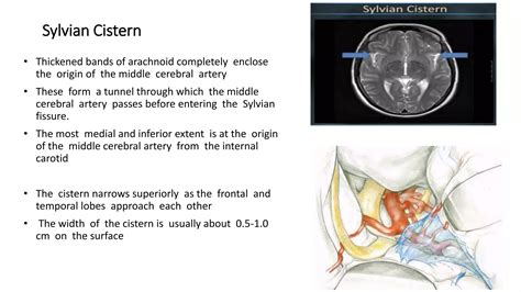 Anatomy Of Subarachnoid Cisterns Of Brain Pptx