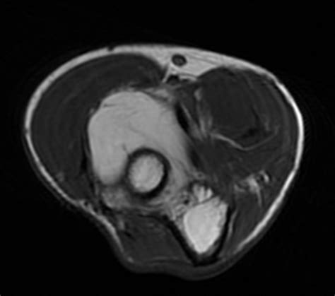 Ewing Sarcoma Mri