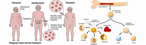 Bone Marrow Transplant