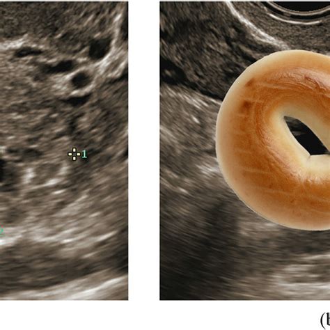 Pdf “the Bagel And Blob Signs In Tubal Ectopic Pregnancy”