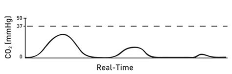 Principles Capnography Flashcards Quizlet