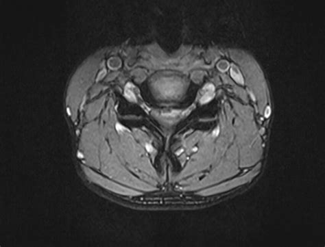 Preoperative Mri Showed Giant Cervical Disc Herniation Download