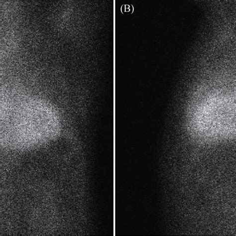 99m Tc Pyrophosphate Scintigraphy Showing A Visual Score Of 3 In The Download Scientific