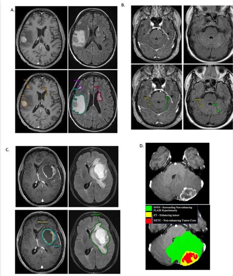 The Brain Tumor Segmentation Brats Mets Challenge 2023 Brain Metastasis Segmentation On Pre