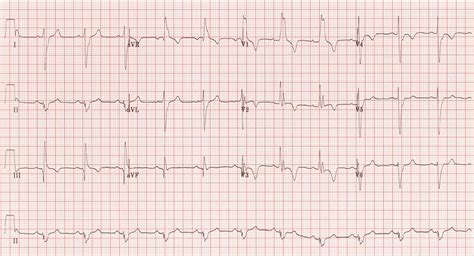 Dominant R Wave In Avr Ecg Book