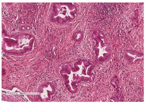 Pathology Of Cholangiocarcinomas