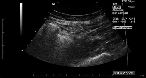 Radiopaedia Case Mesenteric Infarct Id 76112 Study 87627 Nc Commons
