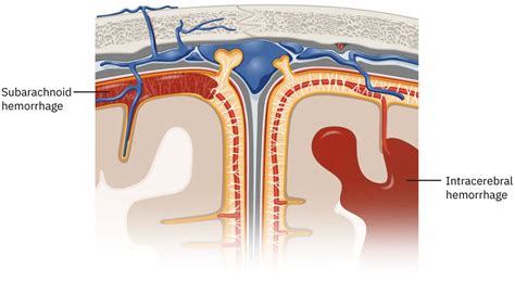 153 Hemorrhagic Stroke Medical Surgical Nursing Openstax
