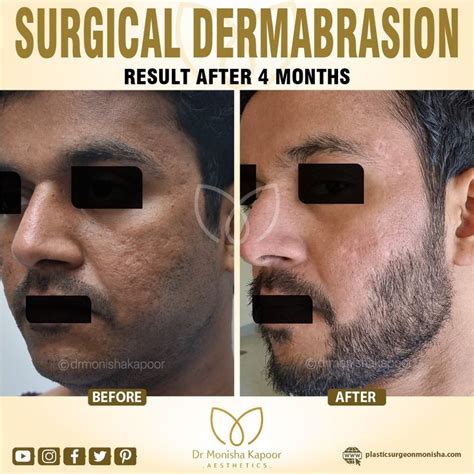 Surgical Dermabrasion Procedure Skin Resurfacing Before And After