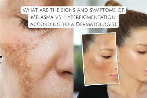 What Are The Signs And Symptoms Of Melasma Vs Hyperpigmentation