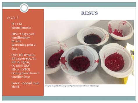 Post Tonsillectomy Bleed — Learned